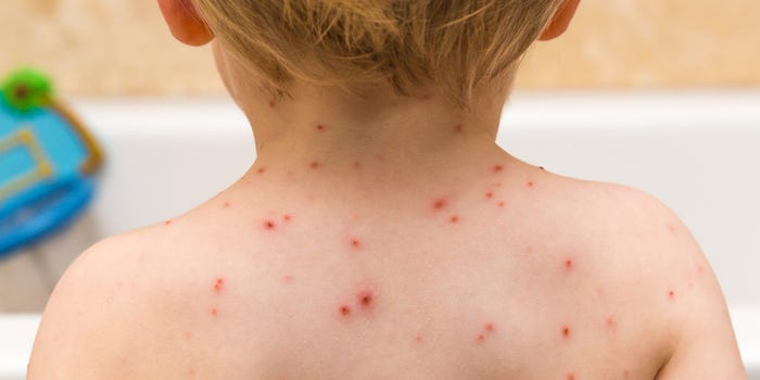 Chickenpox – Symptoms and causes